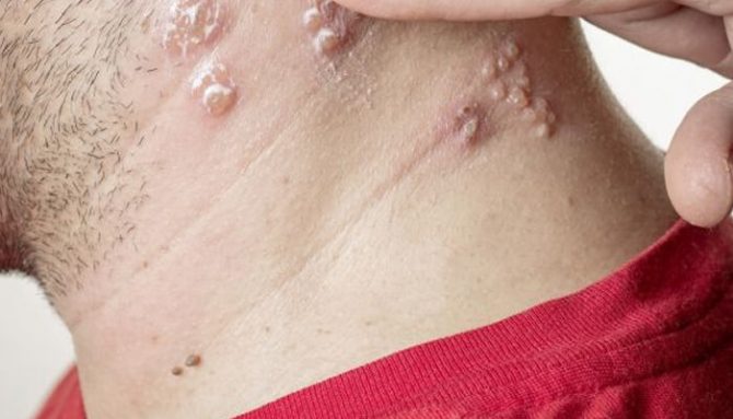 Pásový opar - Jak si s ním poradit co nejrychleji?