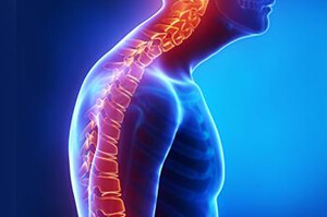 Kyfóza - Kulatá záda - pomoc z přírody | HillVital